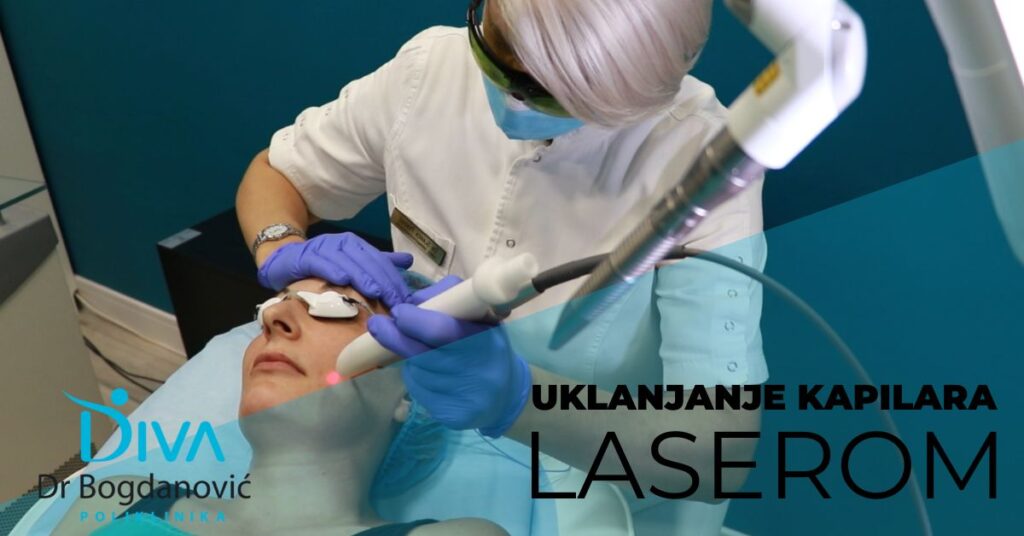 uklanjanje-kapilara-laserom-poliklinika-diva-dr-bogdanovic-beograd ...